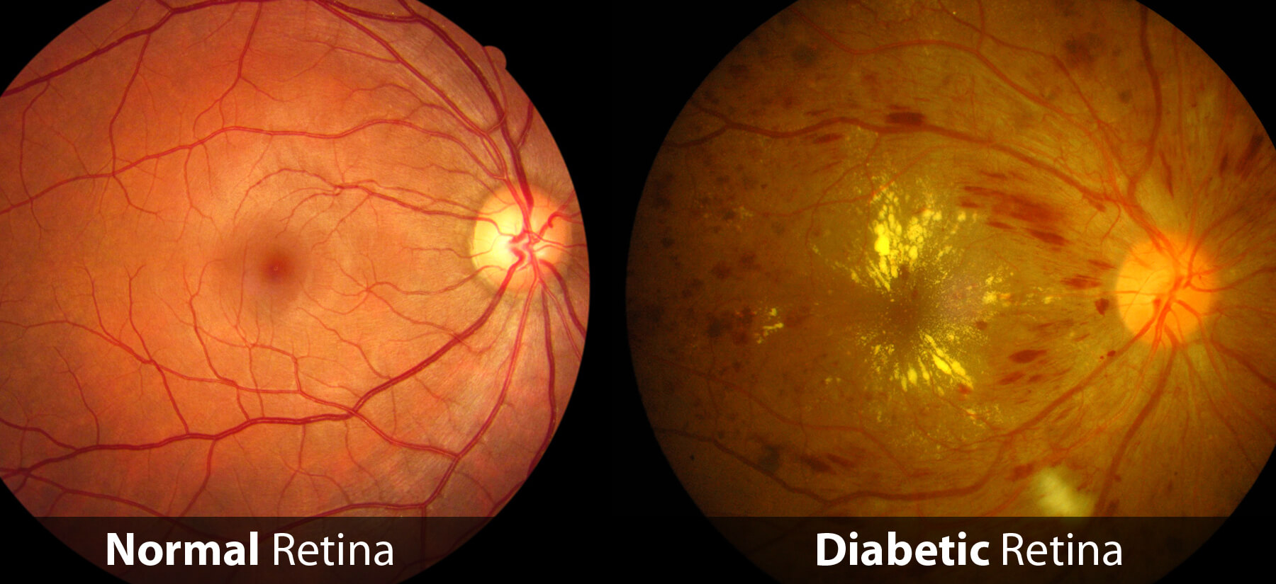 Retina Services Philadelphia Philadelphia Eye Associates
