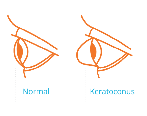 Keratoconus Philadelphia | Keratoconus Treatment Philadelphia, PA
