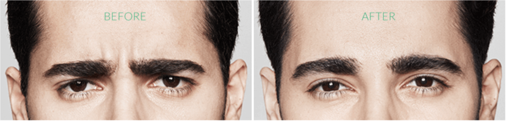 BOTOX® Cosmetic Willingboro, NJ | Philadelphia Eye Associates