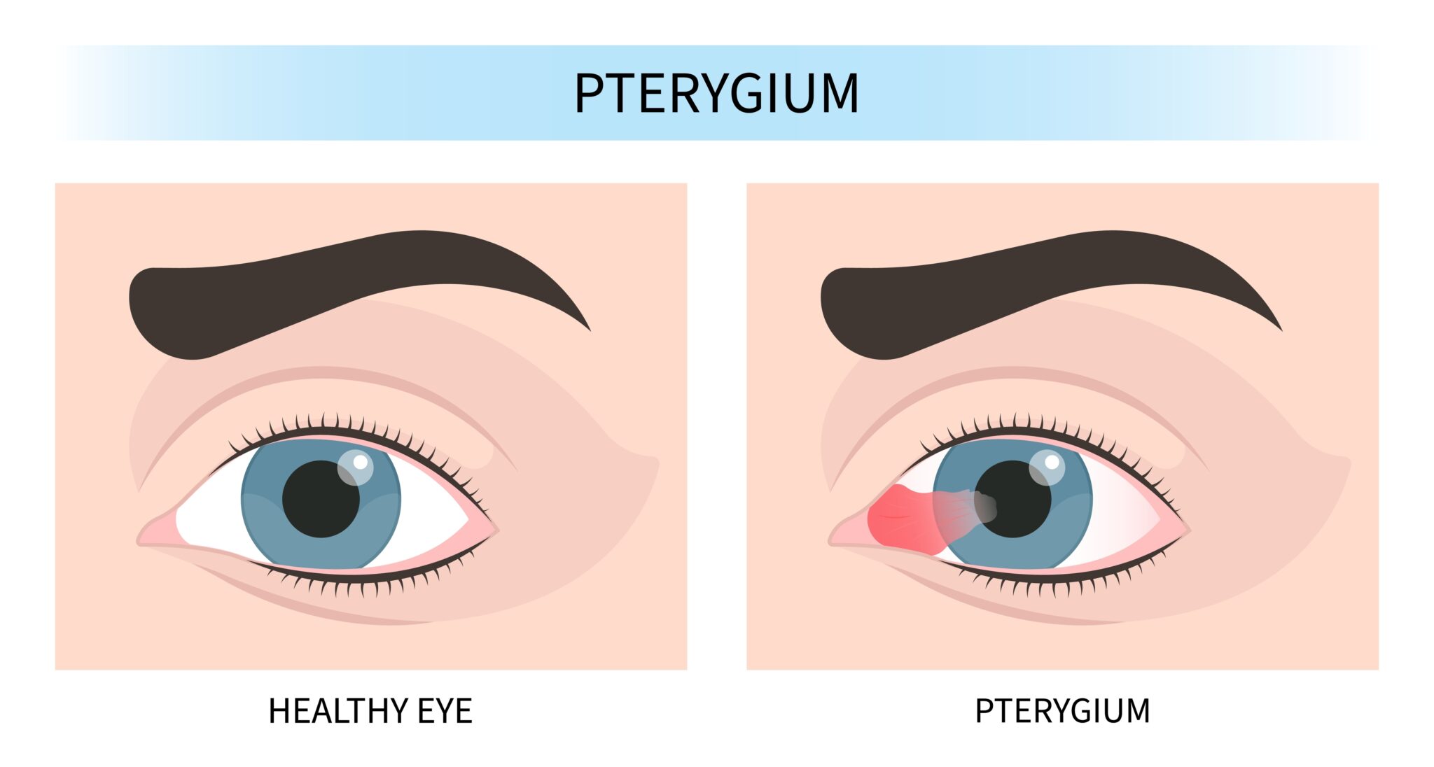 Pterygium Excision | Philadelphia Eye Associates